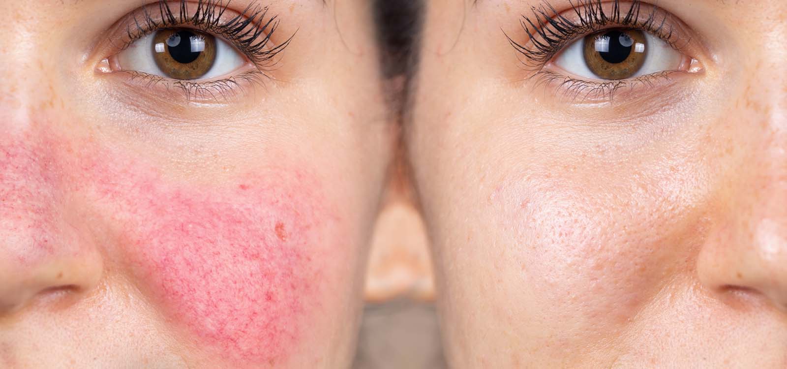 Understanding and Treating Rosacea - Boise Dermatology & Medspa
